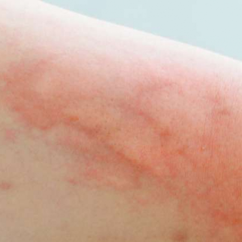 Allertec® Effect - lek przeciwalergiczny zawierający bilastynę